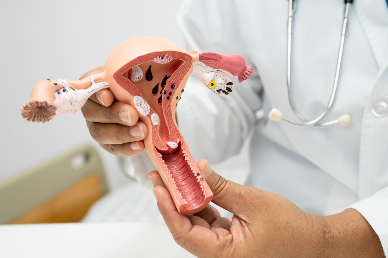 Fibroid Uterus - drkratimehtachandak